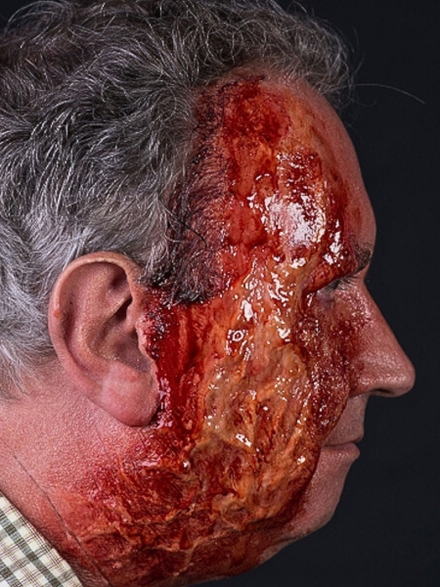 Burns Set 2 | Prosthetics | Monster FX – MonsterFX